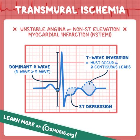 Ischemia Vs Infarction Ecg