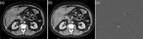 A Ldct Abdomen Image B Tissue Attenuation Component Image After