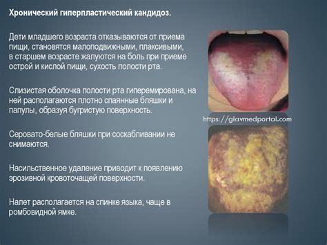 Кандидоз слизистой оболочки полости рта презентация онлайн