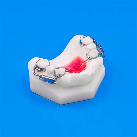 Rapid Molar Distalizer Specialty Appliances