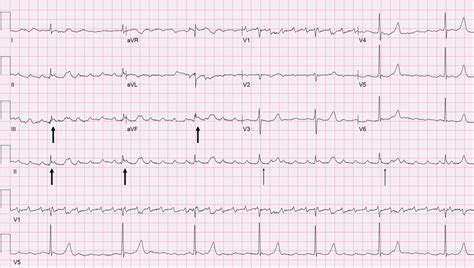 Another Electrocardiogram When Av Conduction During Atrial Flutter Is