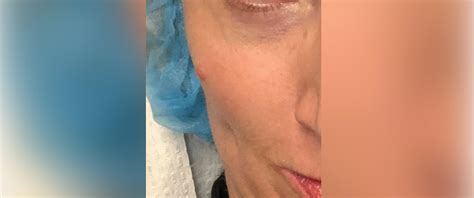 Woman Shares Warning After Mark On Face Diagnosed As Cancerous Tumor 2 Years Later Good