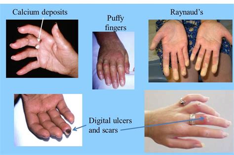 Alternative Herbal Treatment Of Scleroderma Herbs Solutions By Nature