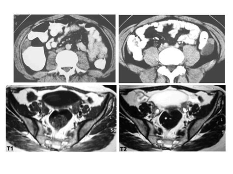 Ovarian Transposition Download Scientific Diagram