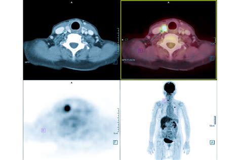 Thyroid Cancer Treatment And Pharmacologic Management
