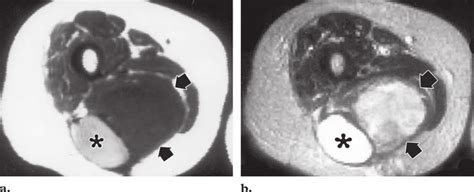Recurrent High Grade Undifferentiated Pleomorphic Sarcoma In A Download Scientific Diagram