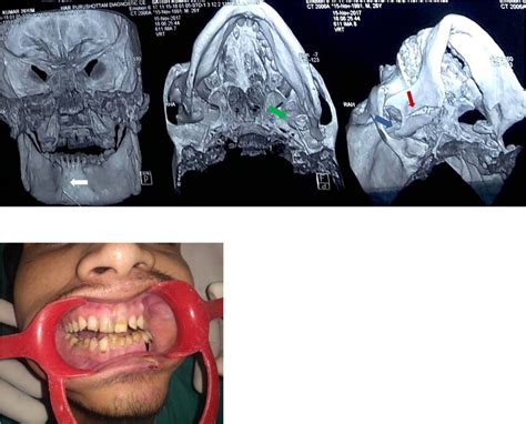 A Ct Scan Reveals Right Ramal Fracture Red Arrow With Dislocated