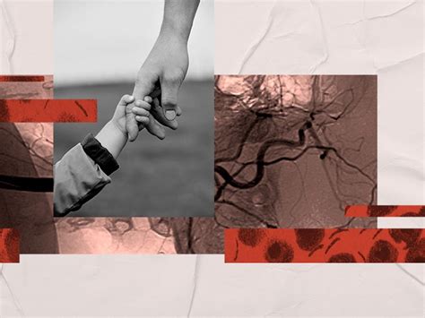 Mixed Hyperlipidemia Causes Risk Factors Treatment And More