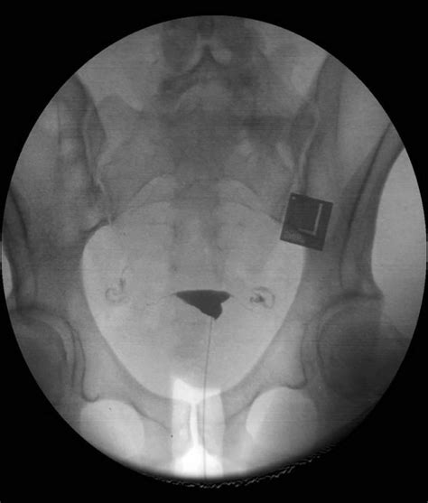 Hysterosalpingogram Procedure Uses And Hysterosalpingogram Side Effects