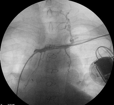 Subclavian Vein Occlusion After Icd Dr Im Plantation Venography After Download Scientific