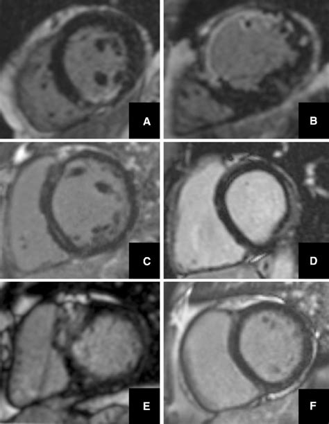 Example Moco Lge Images Illustrating The Variety Of Lge Patterns