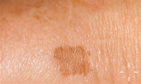 Dermacompass Lentigo Simplex Lentigo Solaris