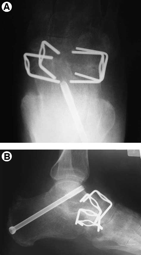 Six Weeks Postoperative Anteroposterior A And Lateral Radiograph B Download Scientific