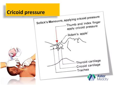 Cricoid Pressure Yes Or No Pptx