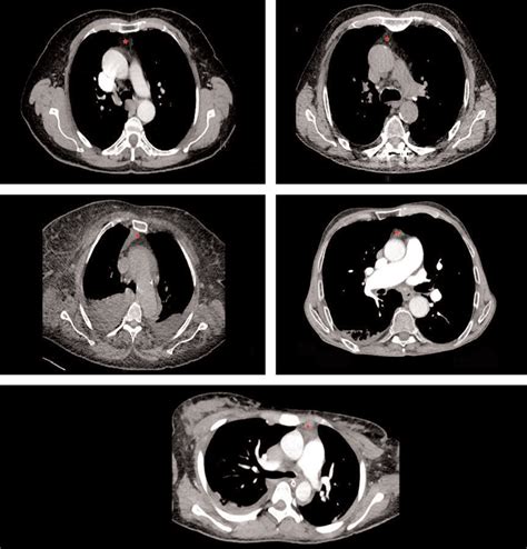 Classification Of The Density Of The Thymus Under 5 Types According To