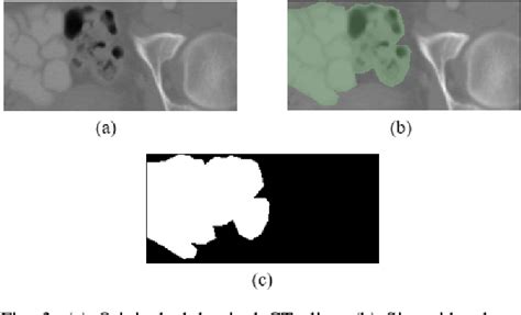 Attention And Pooling Based Sigmoid Colon Segmentation In 3d Ct Images