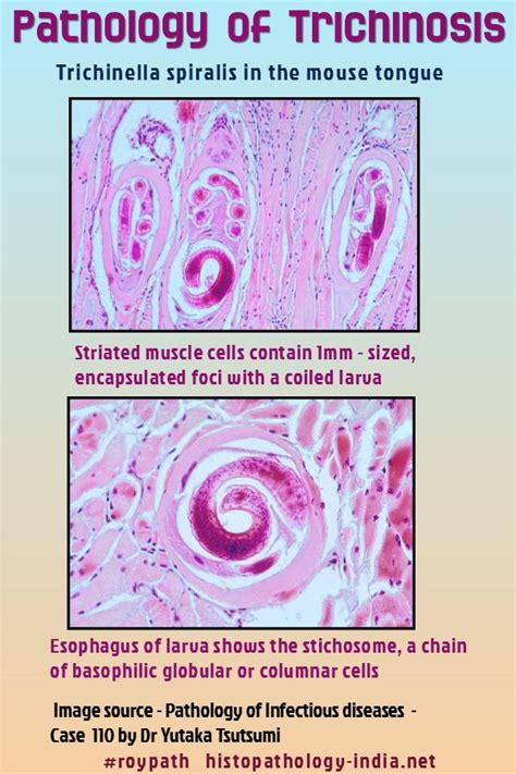 A Guide To Trichinosis Symptoms Treatment And Other Facts 1st Wave