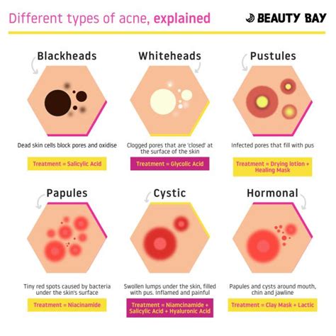 Different Types Of Acne Explained Beauty Bay Edited Different Types Of Acne Types Of