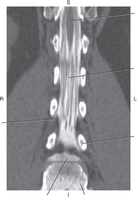 Spinal Cord And Meninges Coronal Plane Labeling Diagram Quizlet