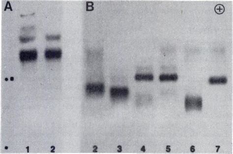 Alp Complexes In Serum Detected By Agarose Electrophoresis A