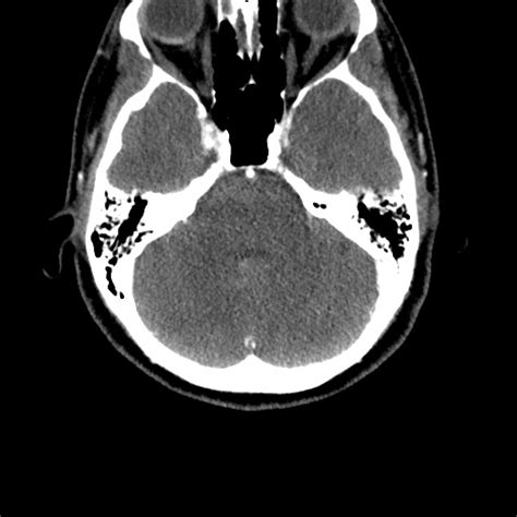 Axial Carotid Artery 5 Radiology Library