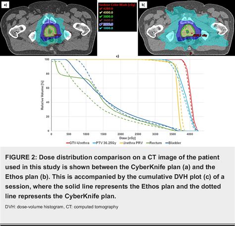 Figure 2 From Ultra Hypofractionated Prostate Radiotherapy With Online Adaptive Technique A