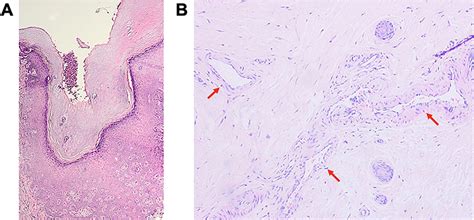 Capecitabine Induced Acquired Palmoplantar Keratoderma Ccid