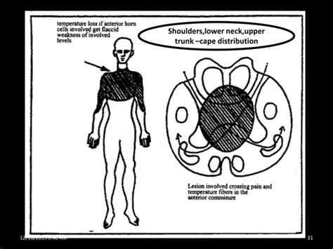 Spinal Cordand Its Lesions Compressive Myelopathy Ppt