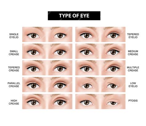 Types Of Eyelids