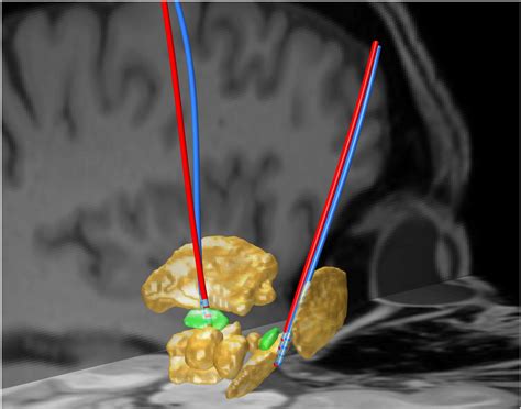From Flood Prediction To Deep Brain Stimulation Fnr