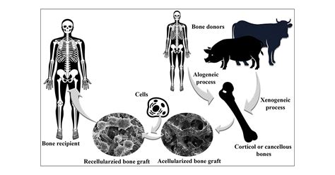 Profet Lumina Soarelui Tulburare Bone Pins System Trinon Titanium Patine Mecanic Câştiga