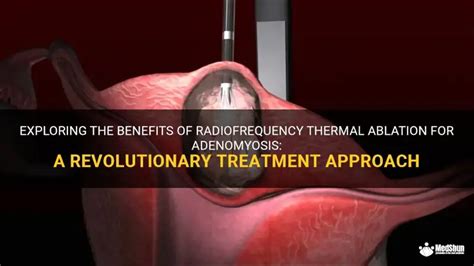 Exploring The Benefits Of Radiofrequency Thermal Ablation For