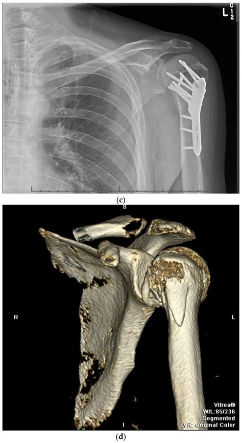 Comminuted Proximal Humerus Fracture