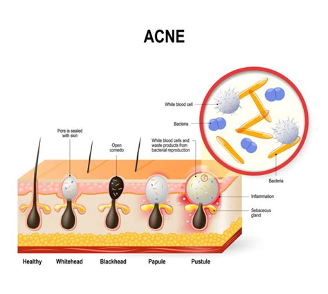 Back Acne Causes Treatment Of Bacne Dr Michele Green M D