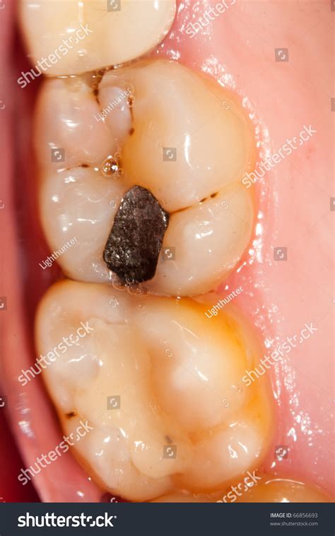 Photograph Posterior Upper Molar Teeth Cavities Foto Stok 66856693