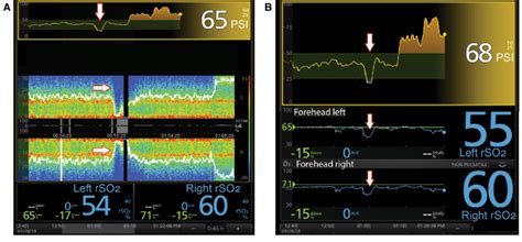 A Processed Electroencephalography Peeg Monitoring Using Two