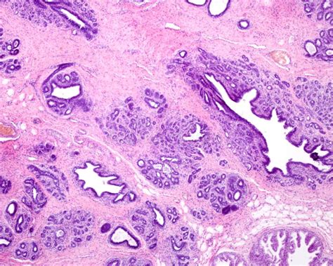 Human Breast Adenosis Stock Illustration Illustration Of Tdlu 312758866