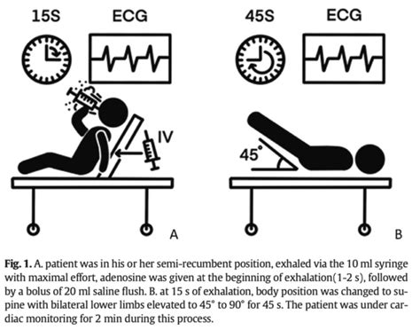 Modified Valsalva Plus Adenosine For Reverting Svt Resus
