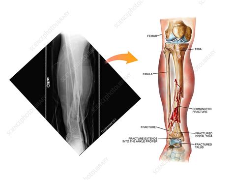 Comminuted Fracture Of The Tibia Stock Image C021 0799 Science Photo Library