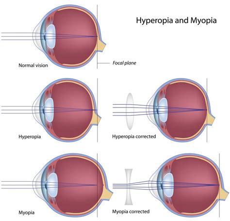 Hyperopia And Myopia Fort Worth Eye Associates
