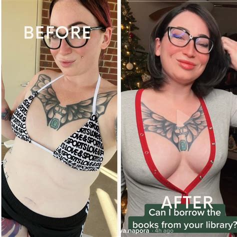 fat transfer to breast 6 week post op r plasticsurgery