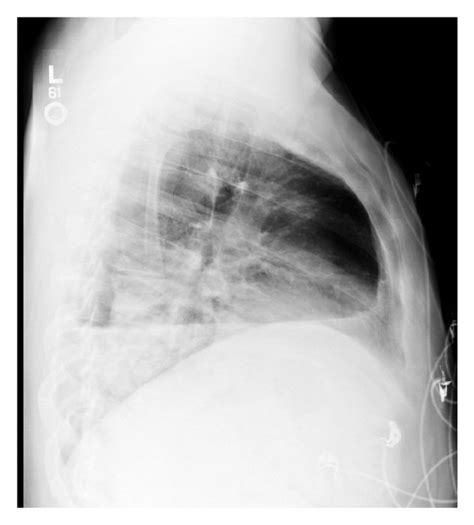 Chest X Ray On Representation Demonstrating Pyopneumothorax Download