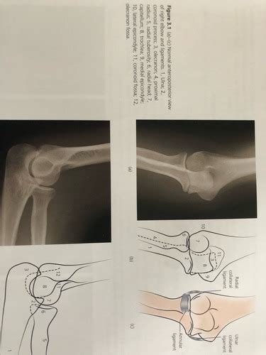 Elbow X Rays Flashcards Quizlet