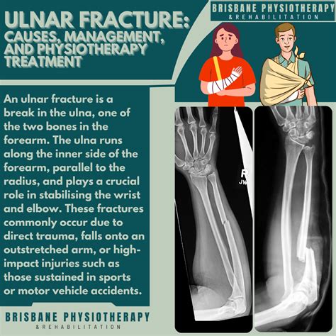 Physiotherapy Guide Ulnar Fractures Brisbane Physiotherapy And Podiatry