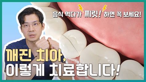 치아 파절깨진 치아 원인과 치료방법 치과 의사 문현국 Youtube