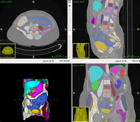 TotalSegmentator v 数据集介绍 知乎