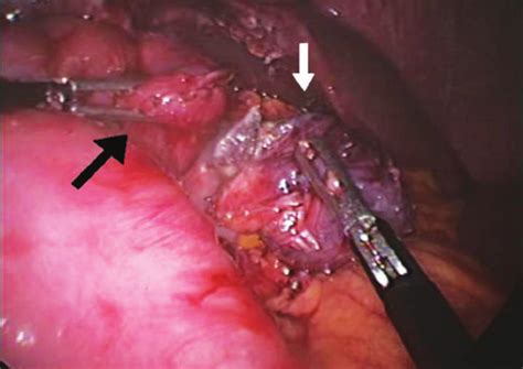 Dilated Loop Clamped And Cut Prior To Removal White Arrow