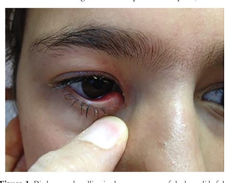 Canaliculitis Symptoms