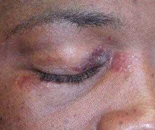 Sarcoidosis And Kaposi Sarcoma Violaceous Plaque On The Eyelid