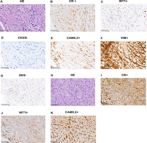 He Staining And Ihc Staining Of Tumor Tissue From The Original Patient